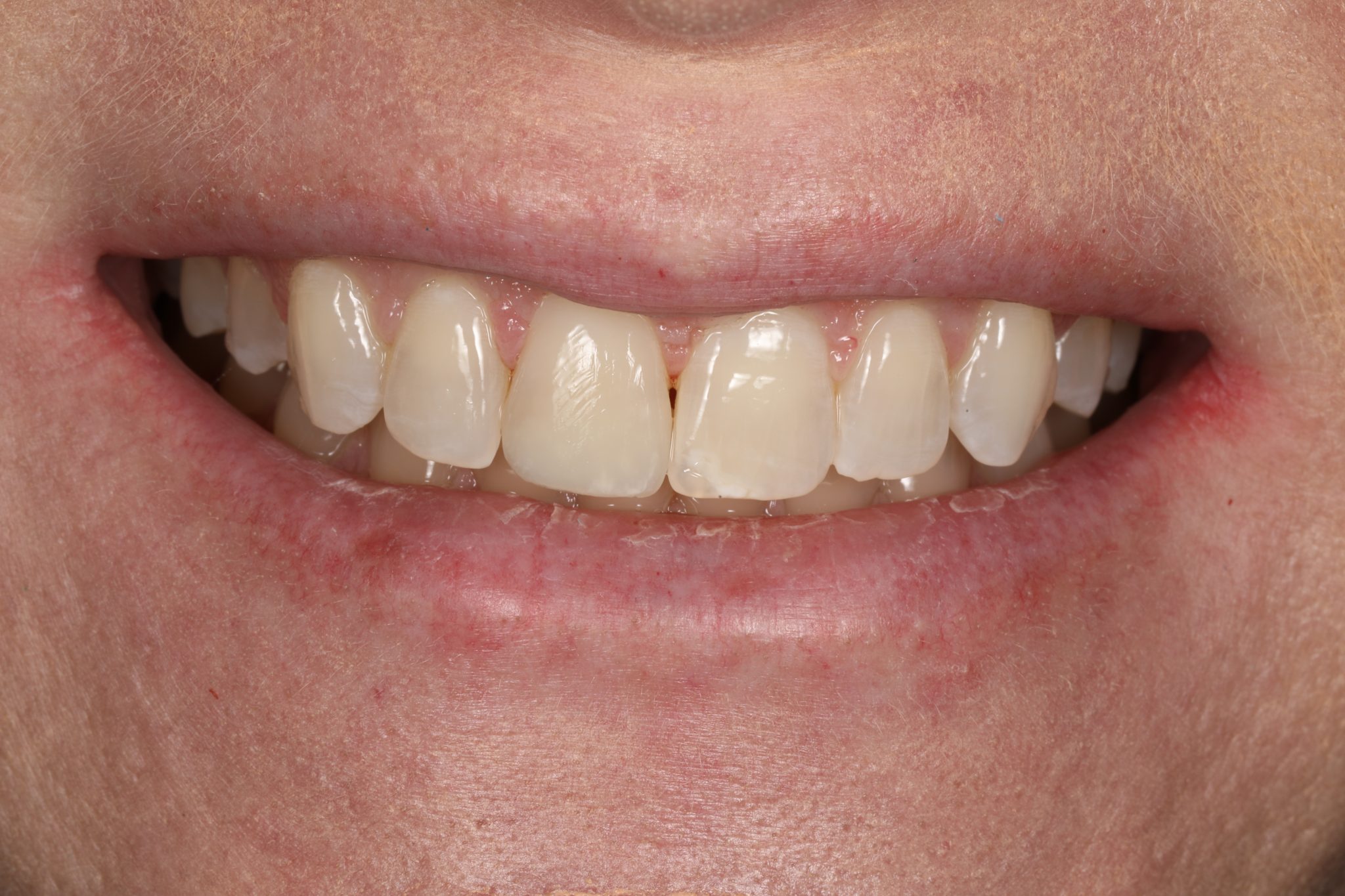 Fixing Fractured Teeth | Hardin Advanced Dentistry