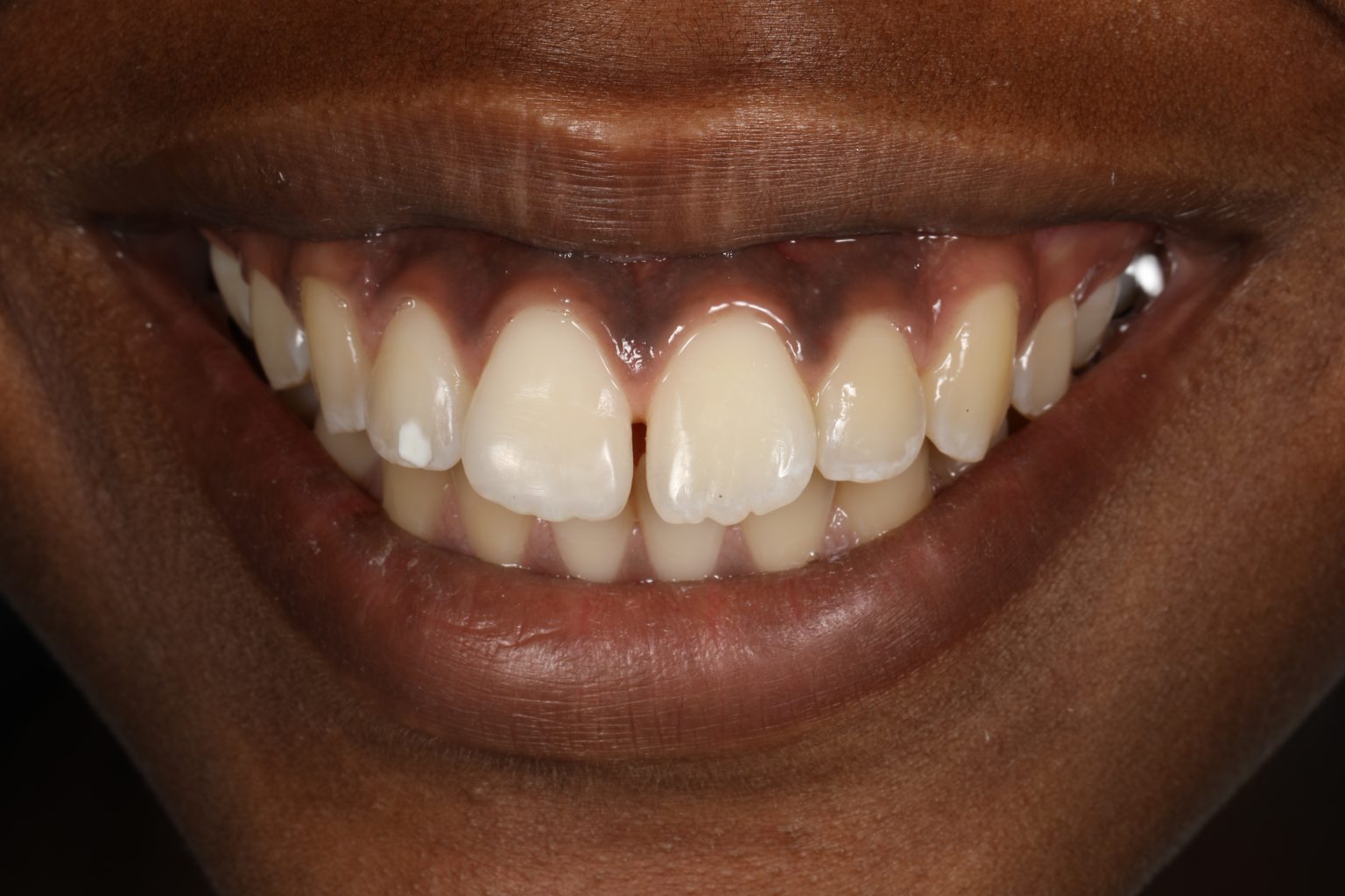 Fixing Fractured Teeth | Hardin Advanced Dentistry