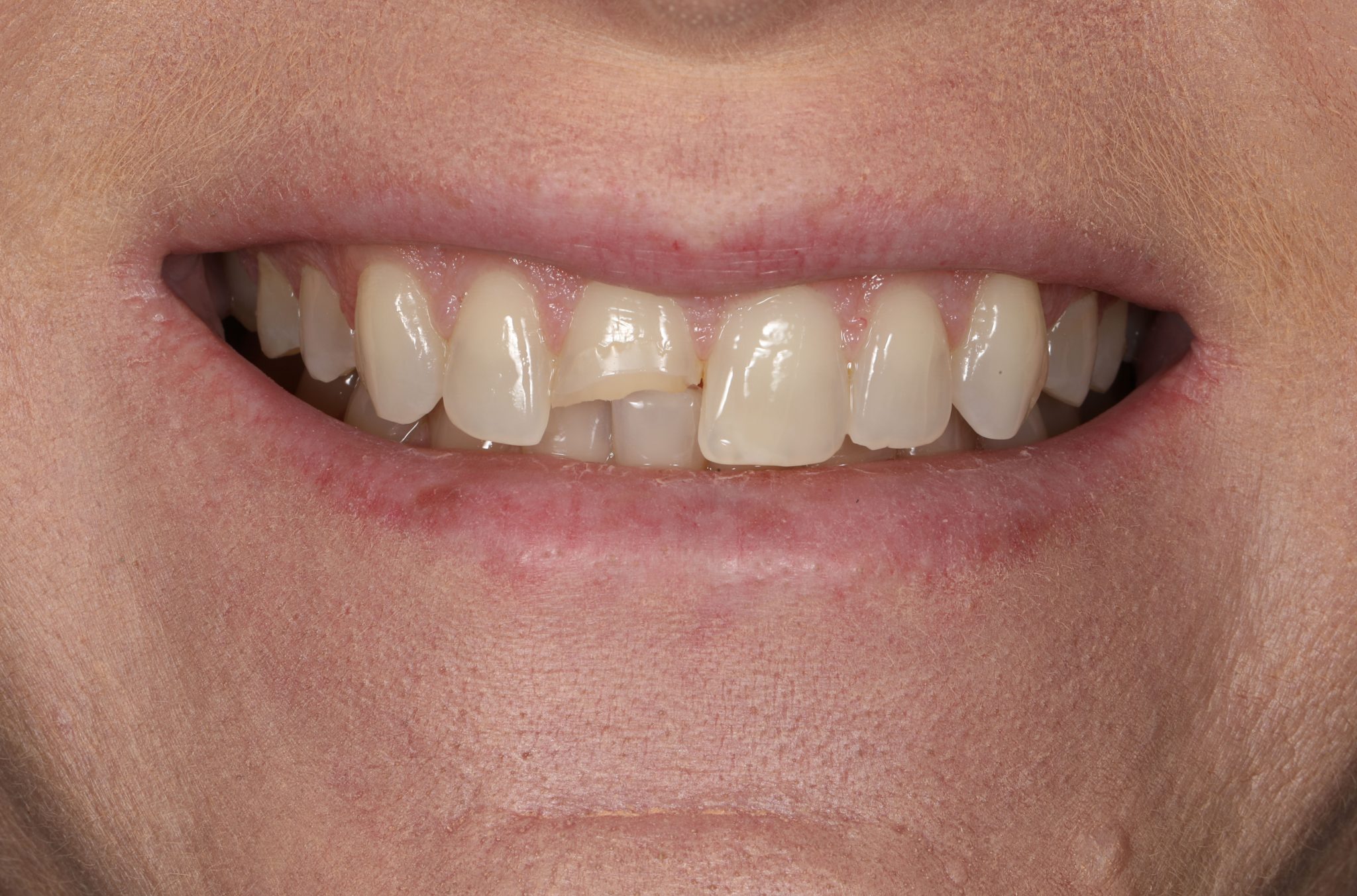 Fixing Fractured Teeth | Hardin Advanced Dentistry