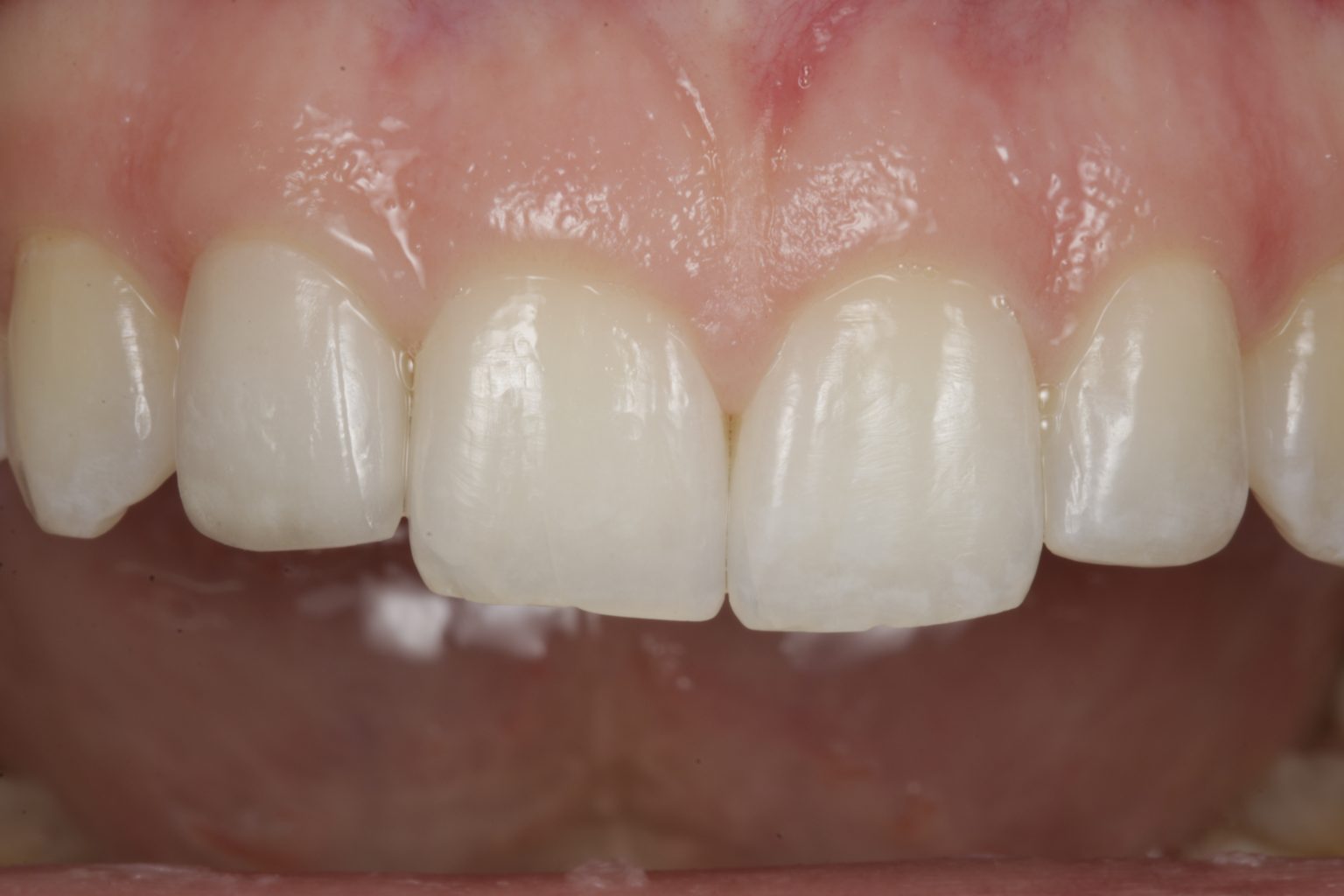 The Art of a Veneer | Hardin Advanced Dentistry