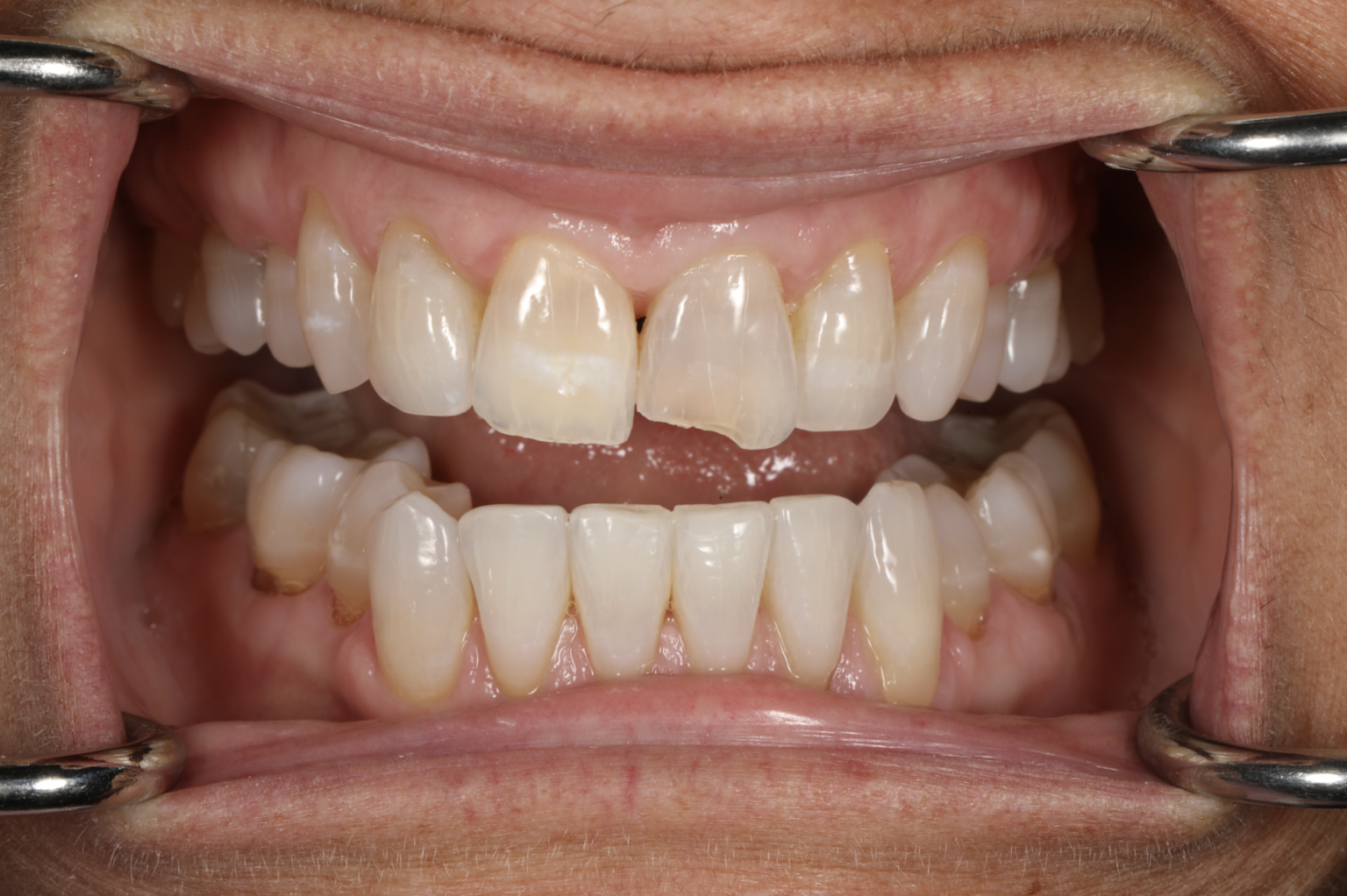 Do You Have a Dark Front Tooth? | Hardin Advanced Dentistry